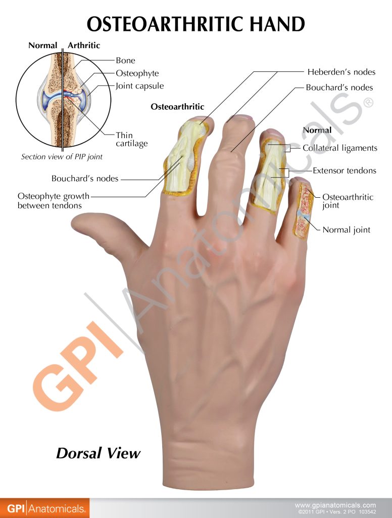 Osteoarthritis Hand Model