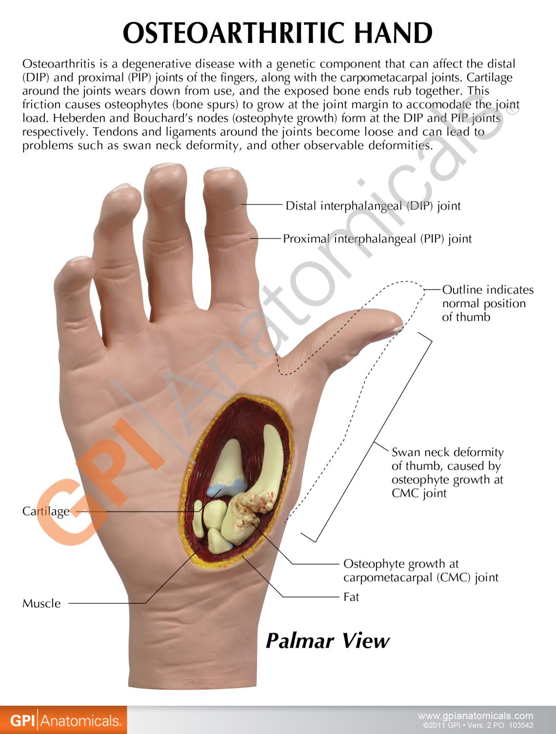 Osteoarthritis Hand Model