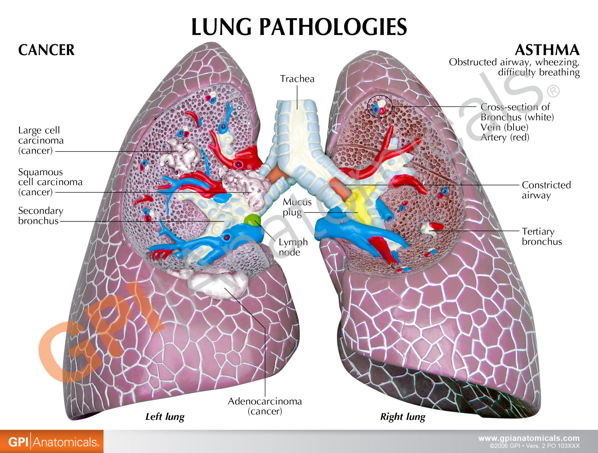 Lung Cancer Model