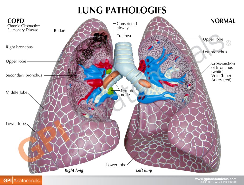 Lung Cancer Model