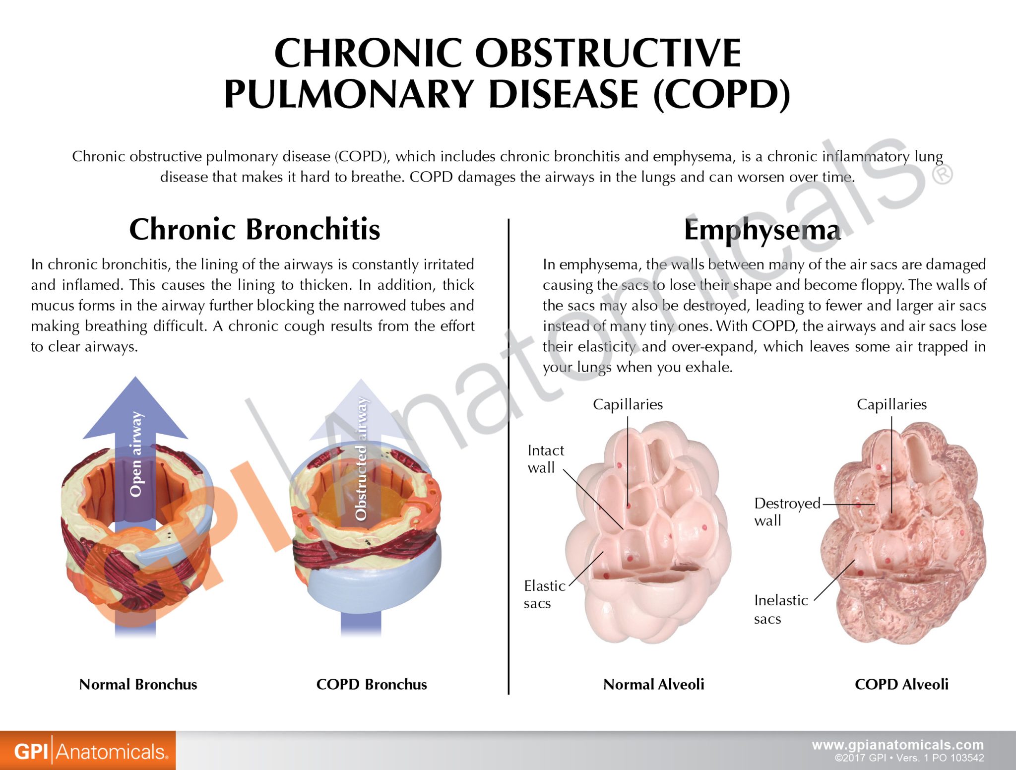 COPD - Model #3130 - GPI Anatomicals