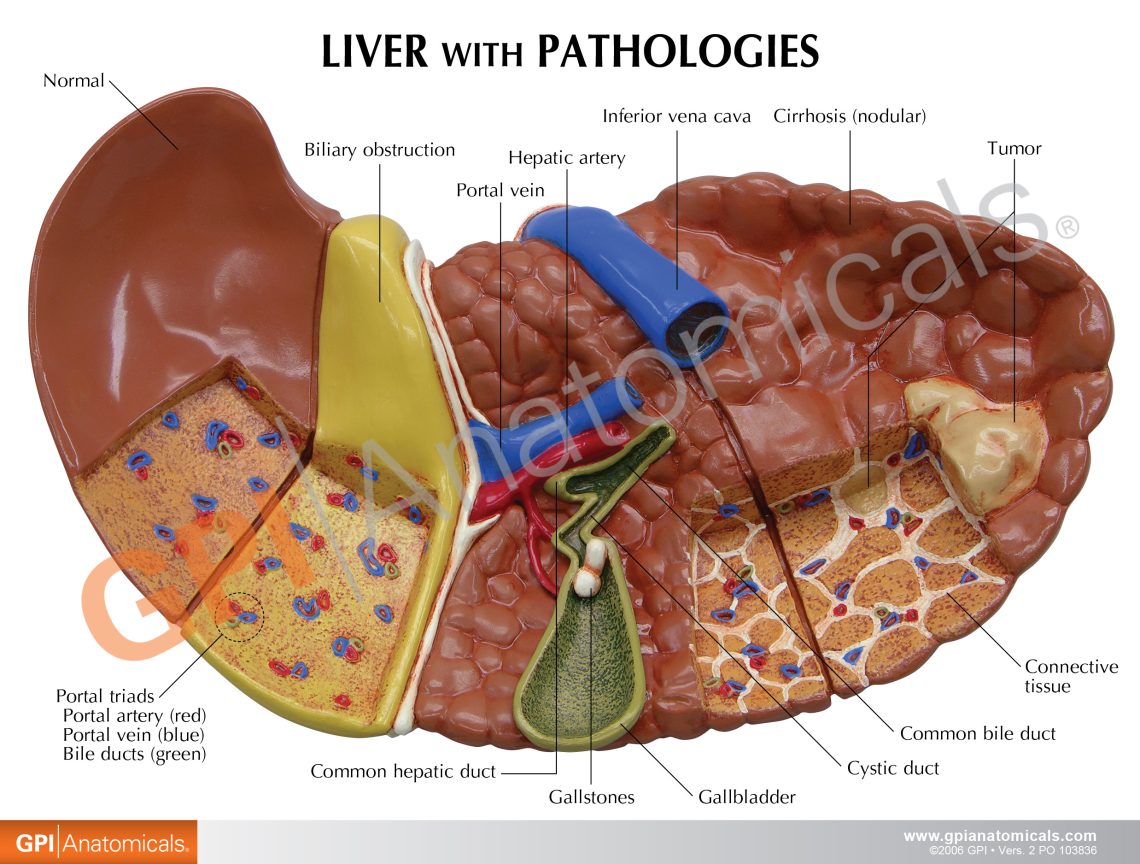 Liver with Pathologies - Model #3310 - GPI Anatomicals