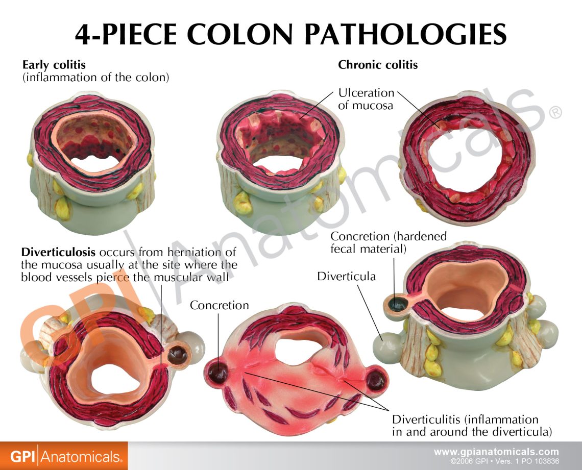 4-Piece Colon with Pathologies - Model #3341 - GPI Anatomicals