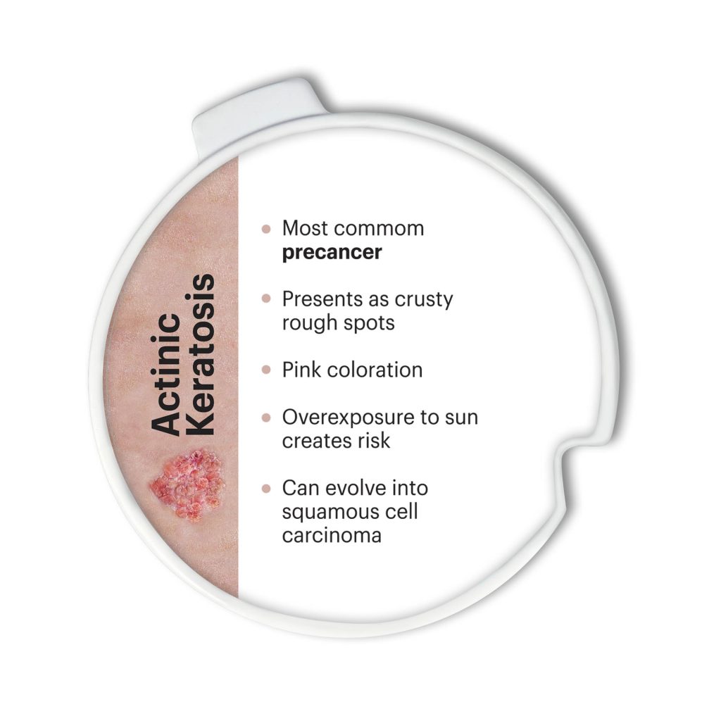 Precancerous and Cancerous Skin Lesions - Model #3851 - GPI Anatomicals