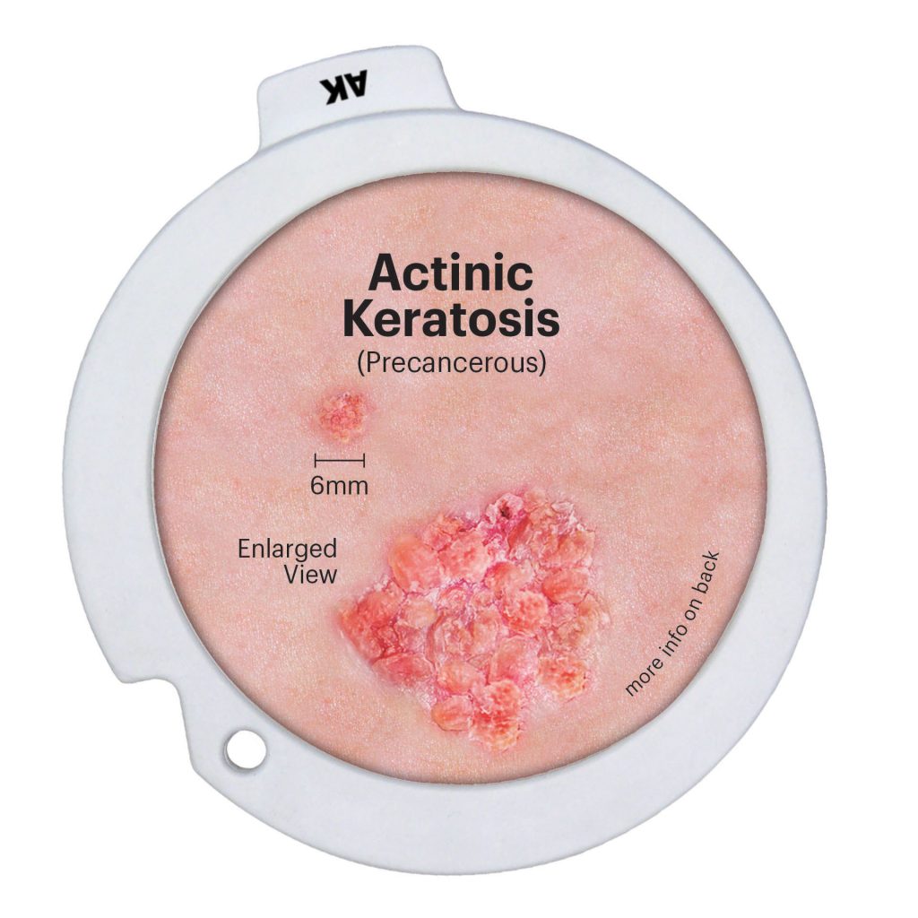 Precancerous and Cancerous Skin Lesions - Model #3851 - GPI Anatomicals