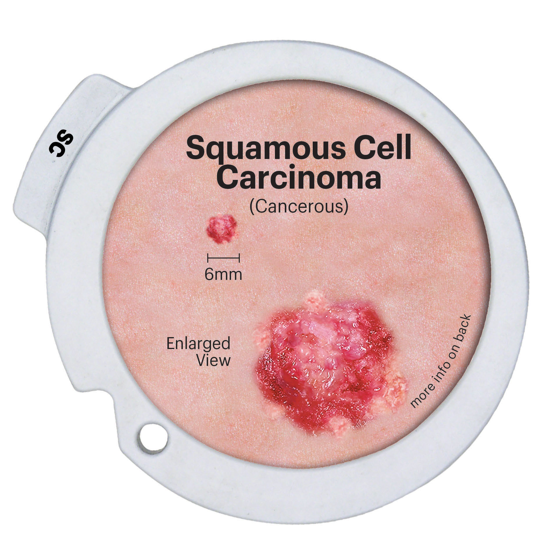 Precancerous and Cancerous Skin Lesions - Model #3851 - GPI Anatomicals