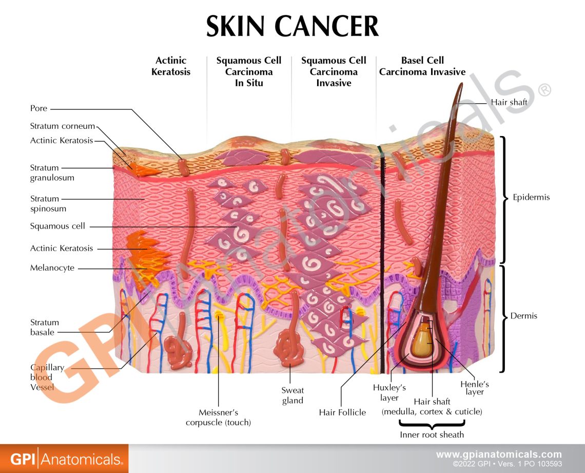 Skin Cancer Model