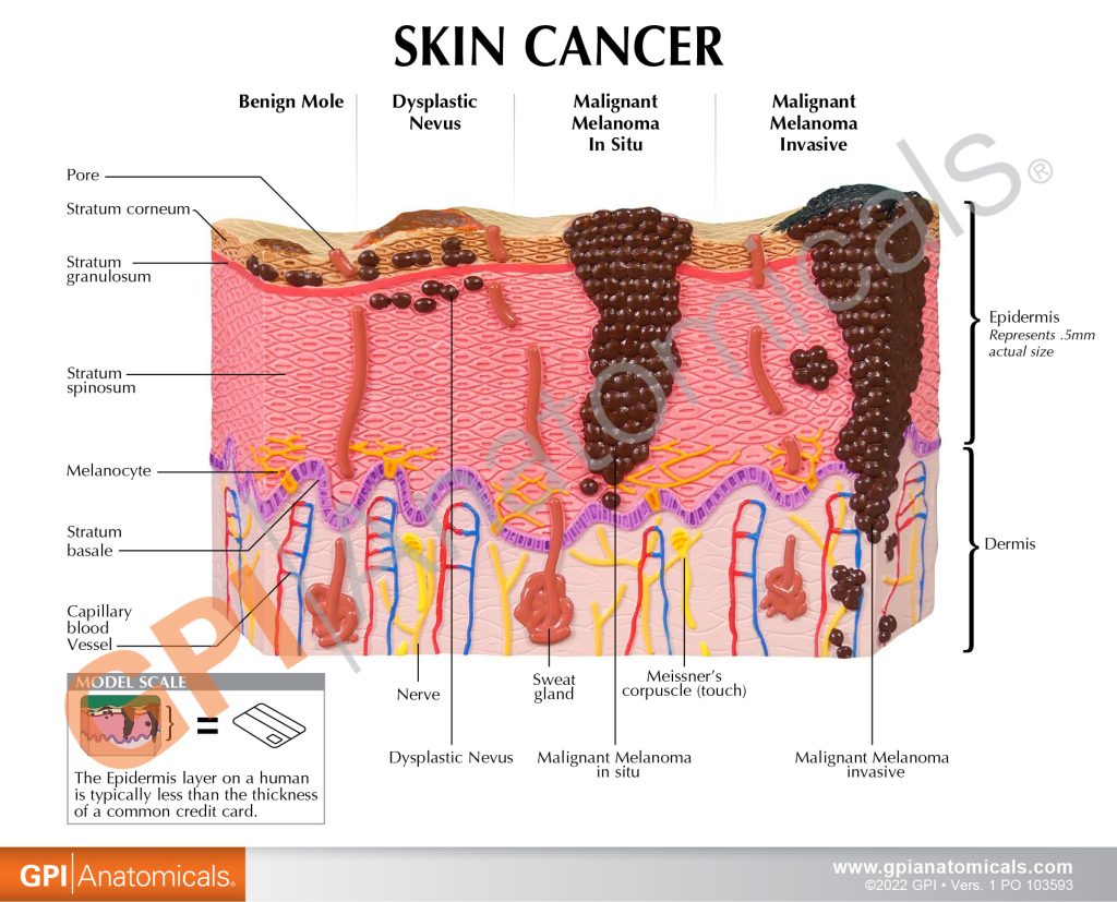 Skin Cancer Model