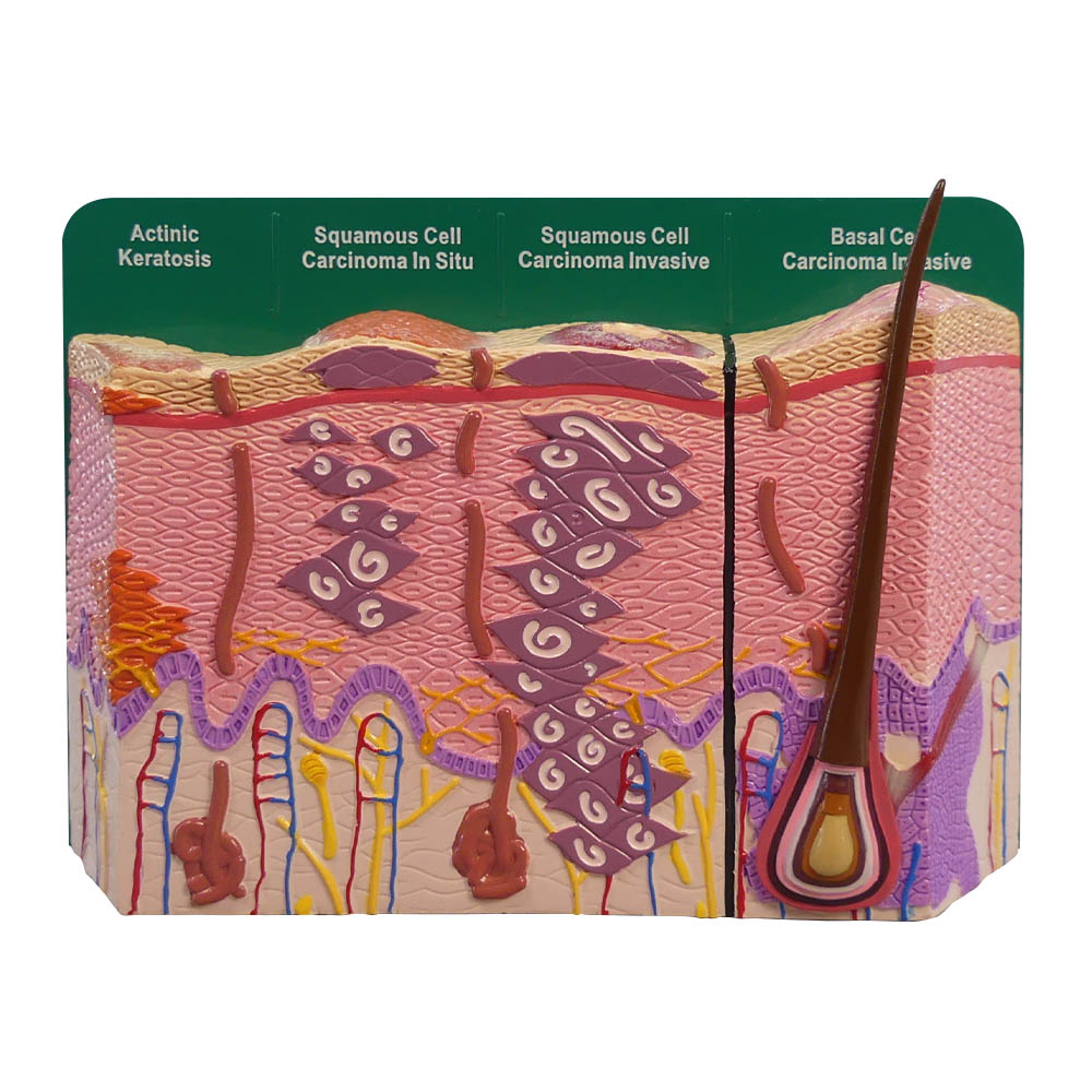 Skin Cancer Model