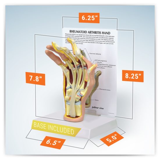 Rheumatoid Arthritis Hand Model