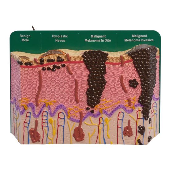 Skin Cancer Model