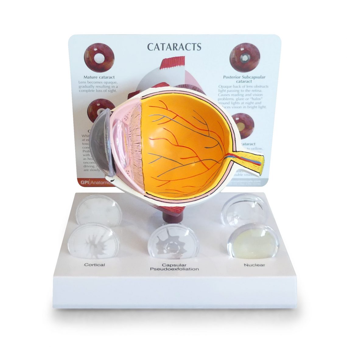 Cataract Eye - Model #2800 - GPI Anatomicals