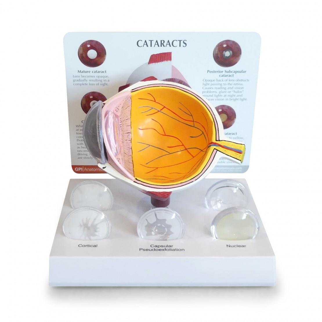 Cataract Eye - Model #2800 - GPI Anatomicals
