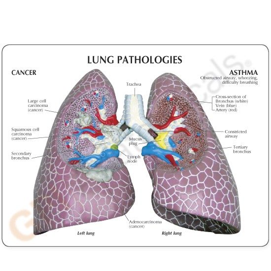 Lung Cancer Model