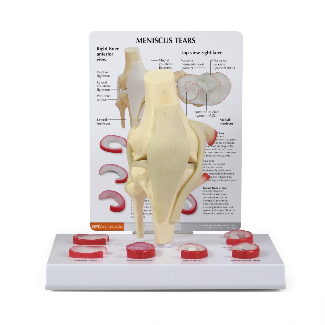 Meniscus Tears - Model #1010 - GPI Anatomicals
