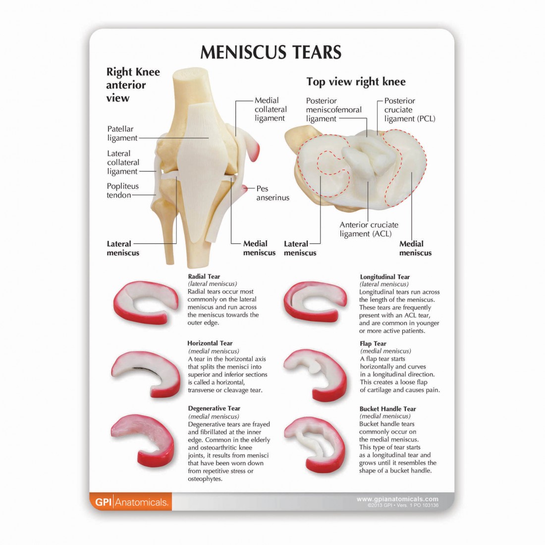 Meniscus Tears - Model #1010 - GPI Anatomicals