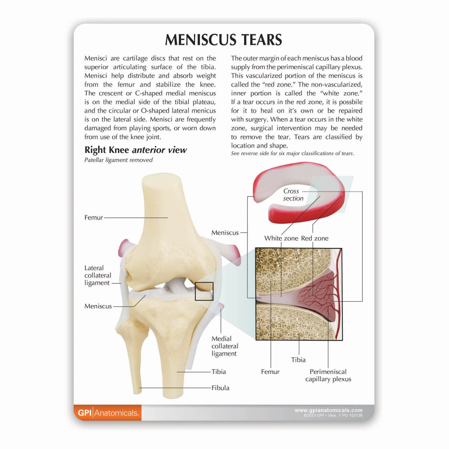 Meniscus Tears - Model #1010 - GPI Anatomicals