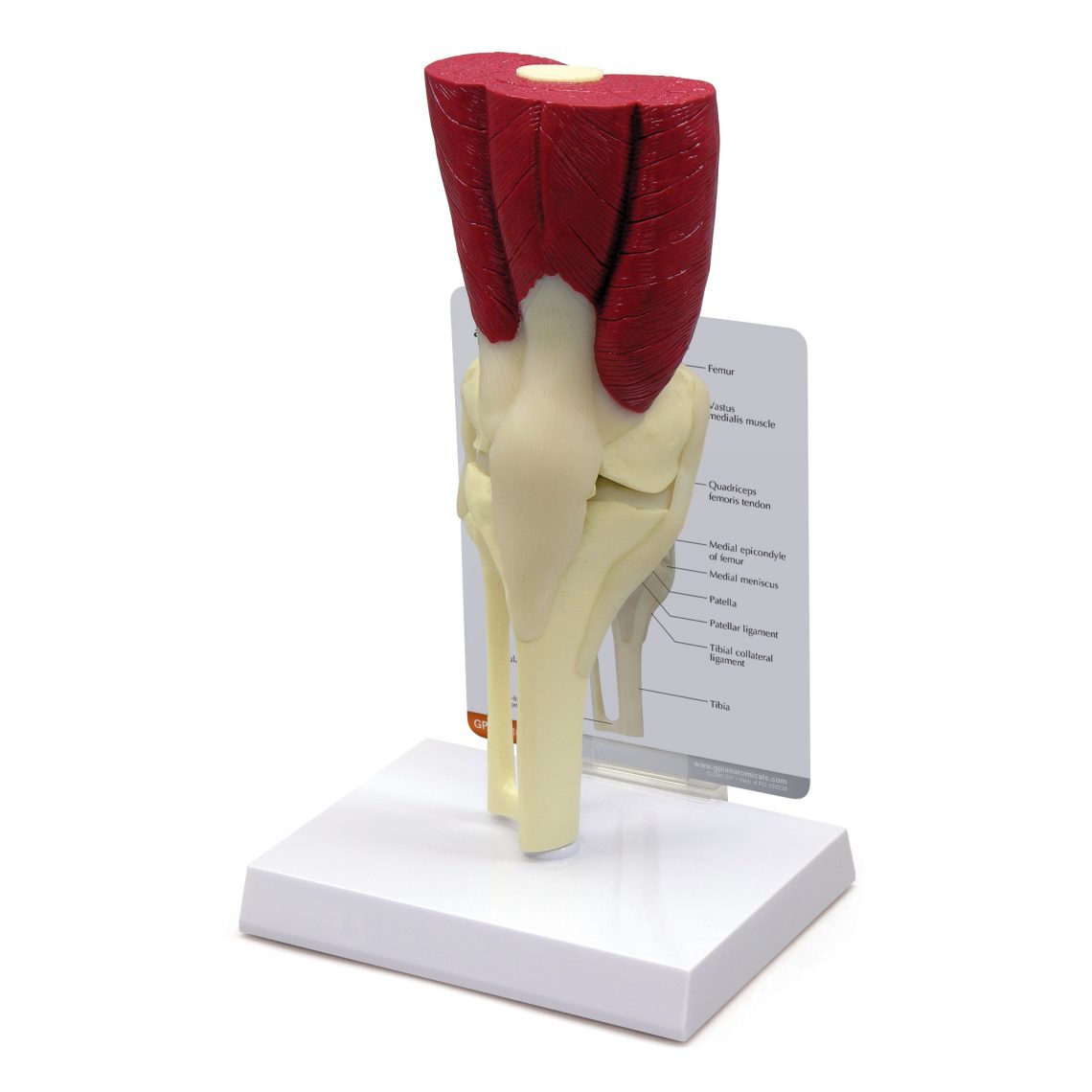 Meniscus Tears - Model #1010 - GPI Anatomicals