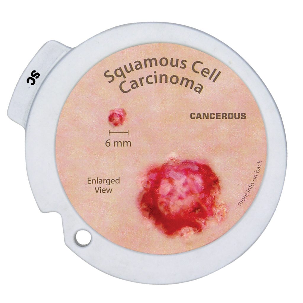 Precancerous and Cancerous Skin Lesions - Model #3851 - GPI Anatomicals